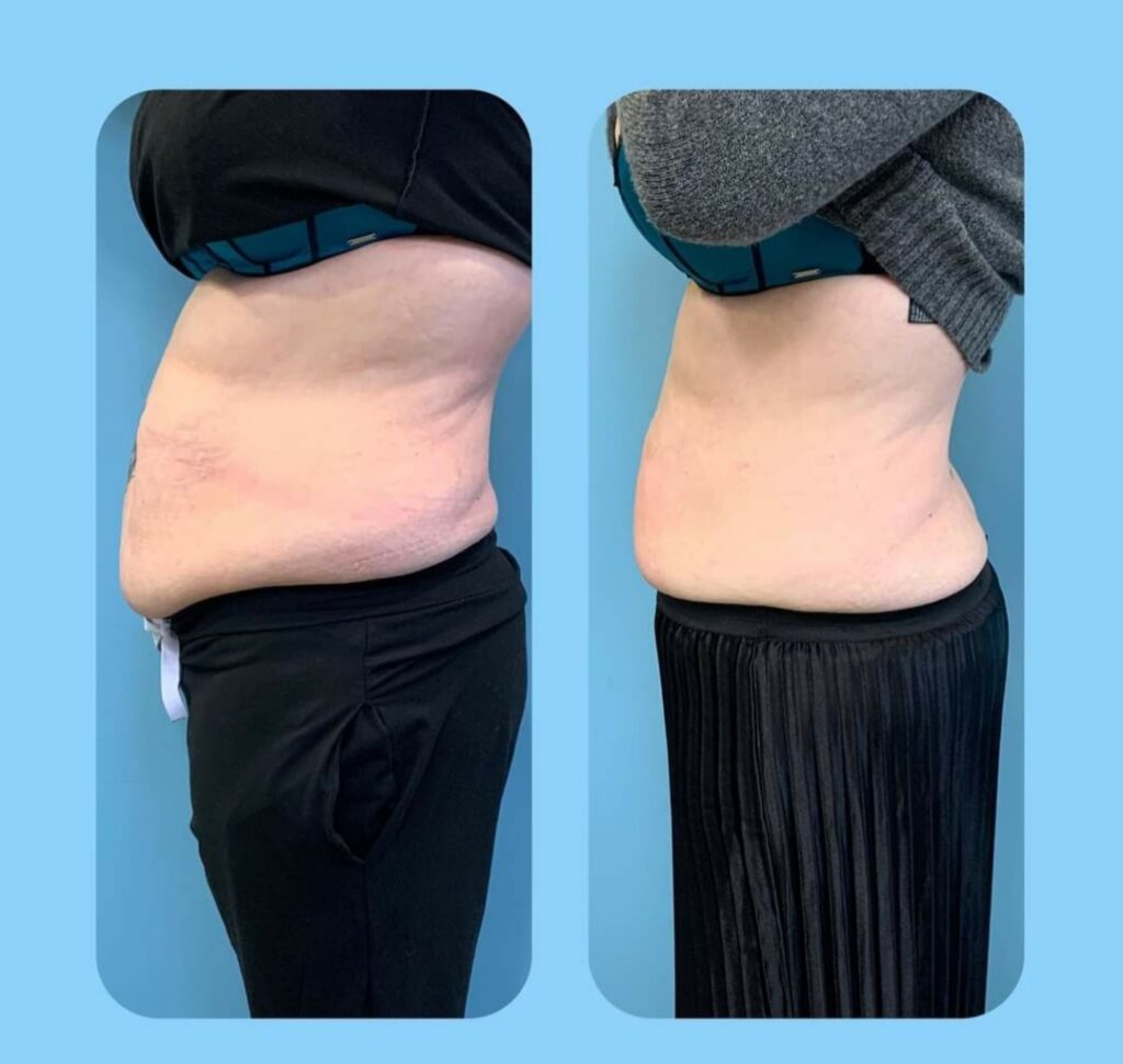 3D Ultimate Pro Body Contouring - Luméra Aesthetics